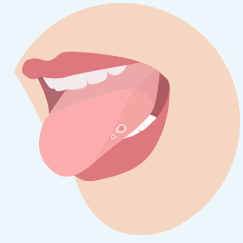 Behcet Syndrome - Treatment and Symptoms - AUTOIMMUNE SISTERS